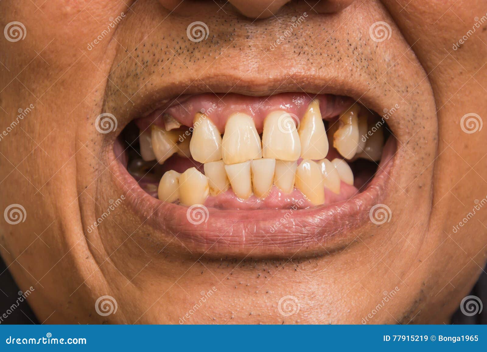 Smoker Teeth Stock Photo | CartoonDealer.com #56180976