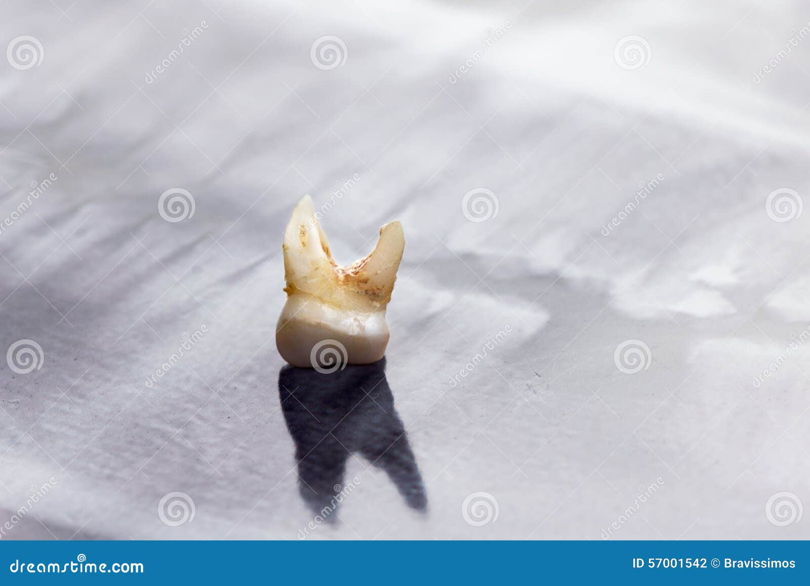 Bad Tooth and X-ray Snapshot Stock Photo - Image of anatomy, disease ...