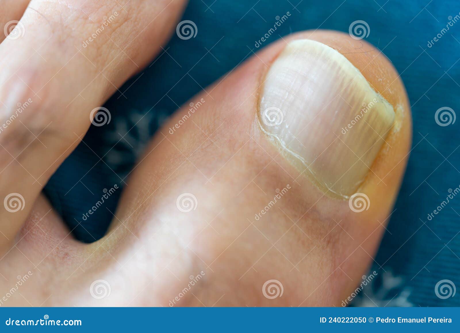 Badly Cut Nail of the Human Big Toe on the Left Side Stock Photo ...