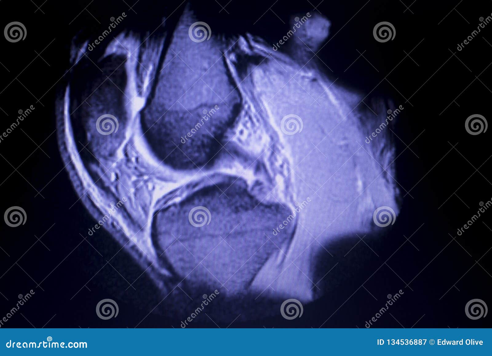 Balayage De Larme De Ménisque De Genou D'IRM Image stock - Image du ...