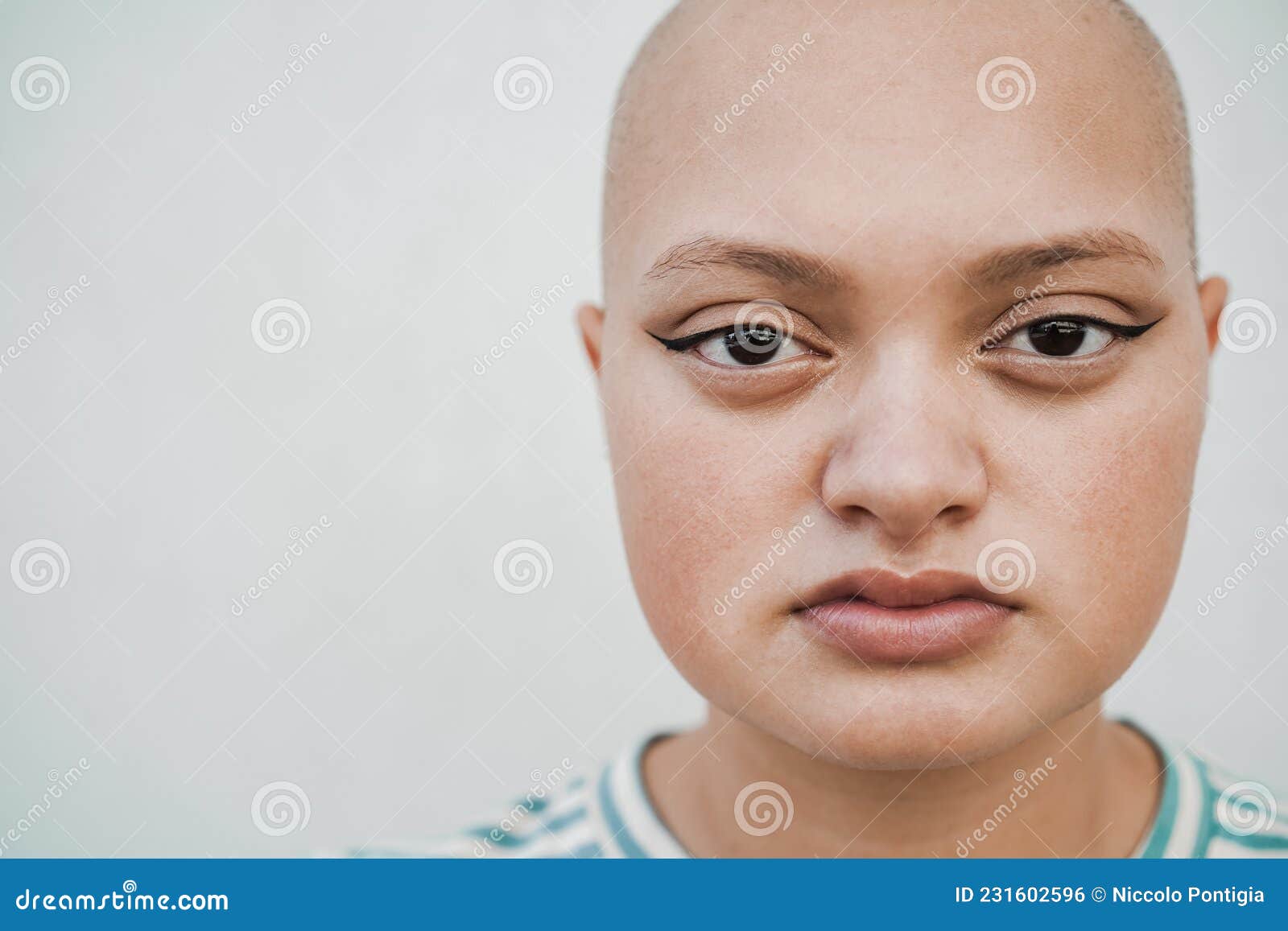 Bald Girl Posing in Front of Camera Outdoor - Focus on Eyes Stock Photo ...