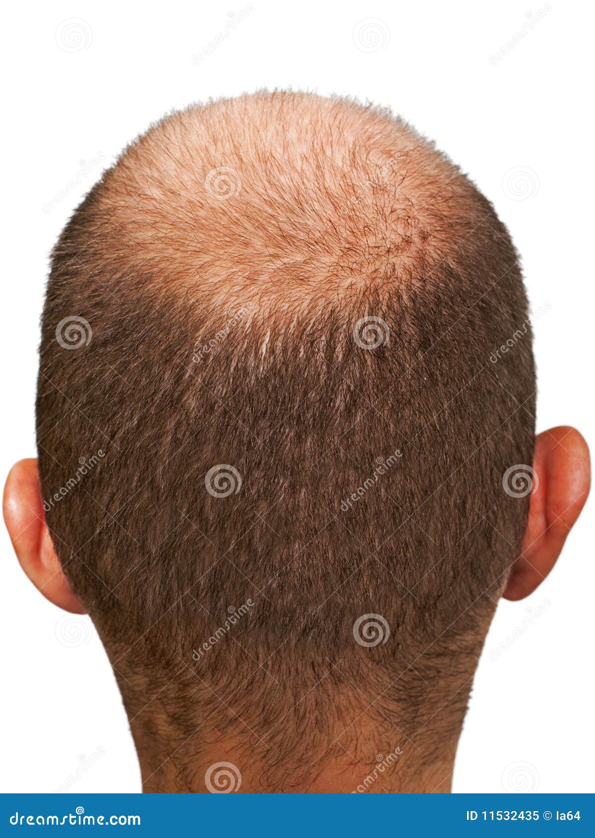 Bald head stock image. Image of human, completely, hair - 11532435