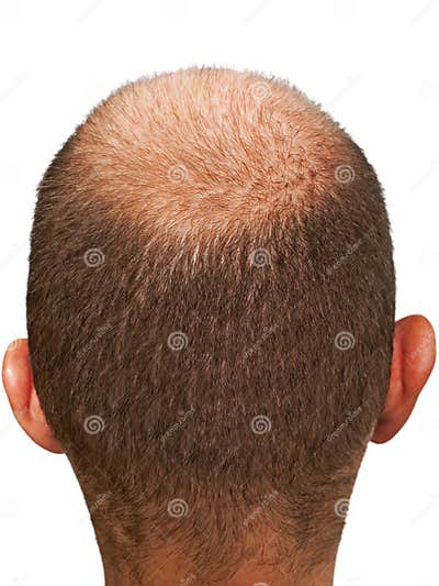 Bald head stock image. Image of human, completely, hair - 11532435