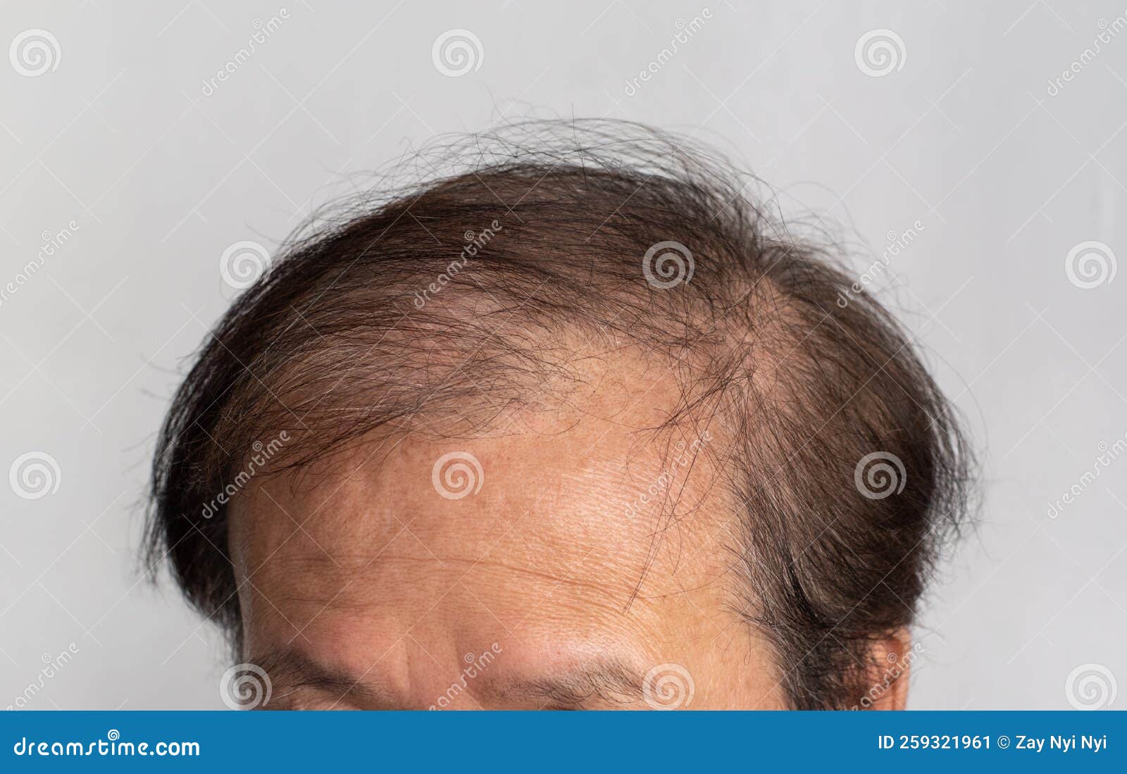 Bald Head of Asian Man. Concept of Male Pattern Hair Loss or Sparse ...