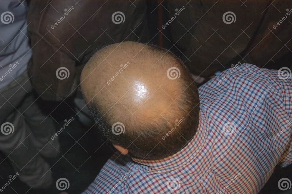 Bald head stock image. Image of balding, head, detail - 35417821