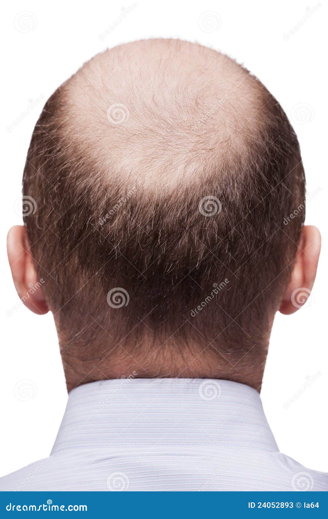 Human Alopecia Or Hair Loss - Adult Man Hands Pointing At His Bald Head ...