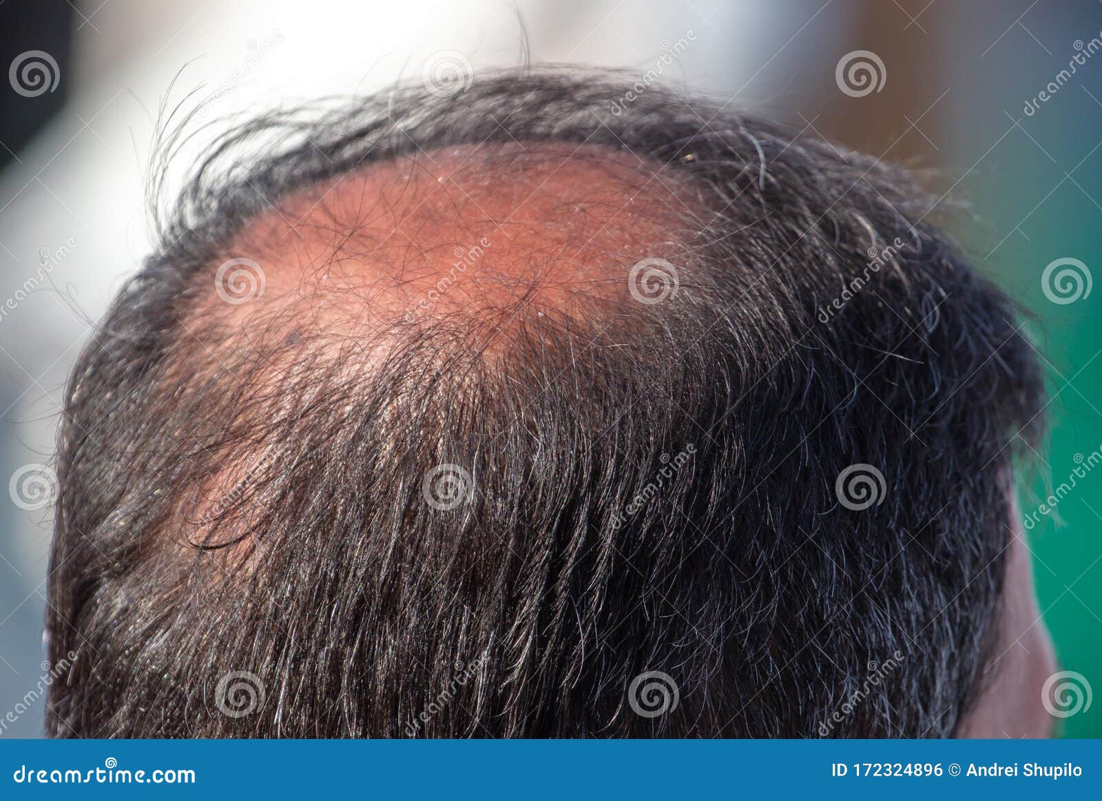 A bald man s head stock photo. Image of health, process - 172324896