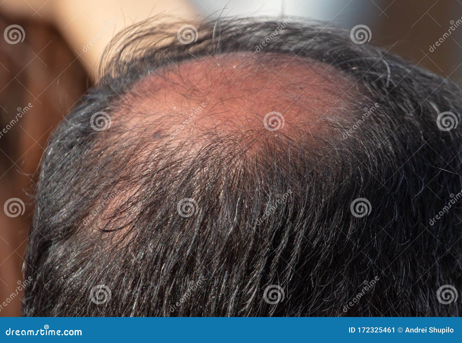 A bald man`s head stock image. Image of growth, face - 172325461