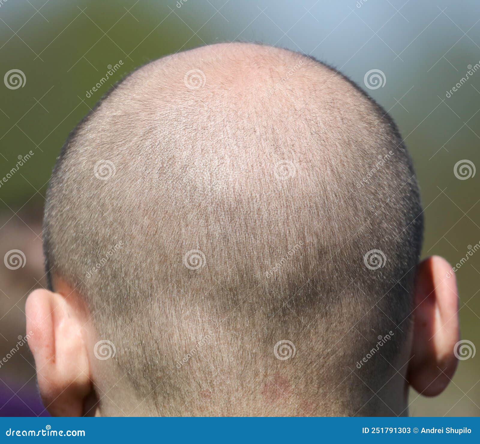Bald Patch on the Head of a Man. Stock Image - Image of healthcare ...