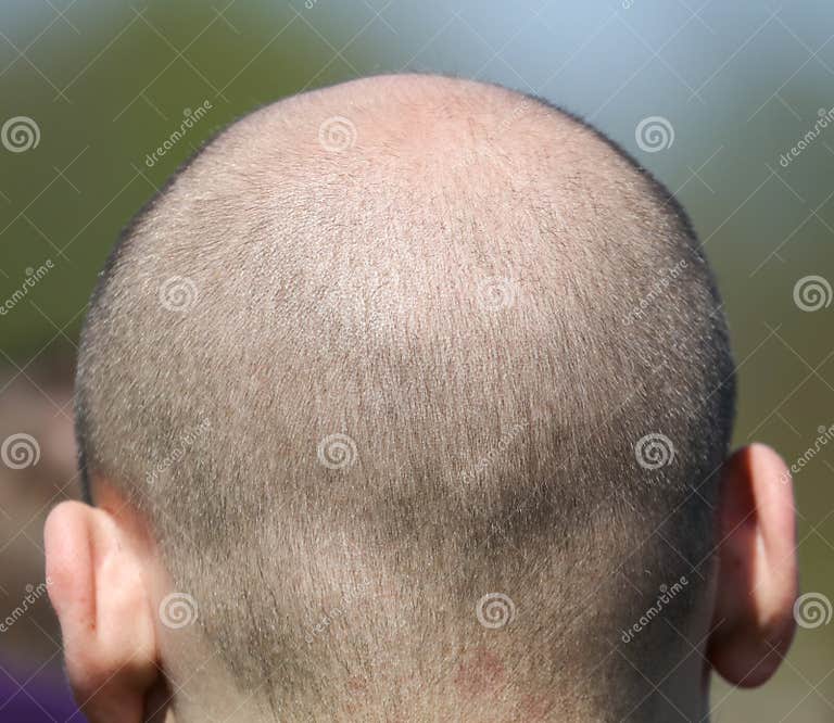Bald Patch on the Head of a Man. Stock Image - Image of healthcare ...