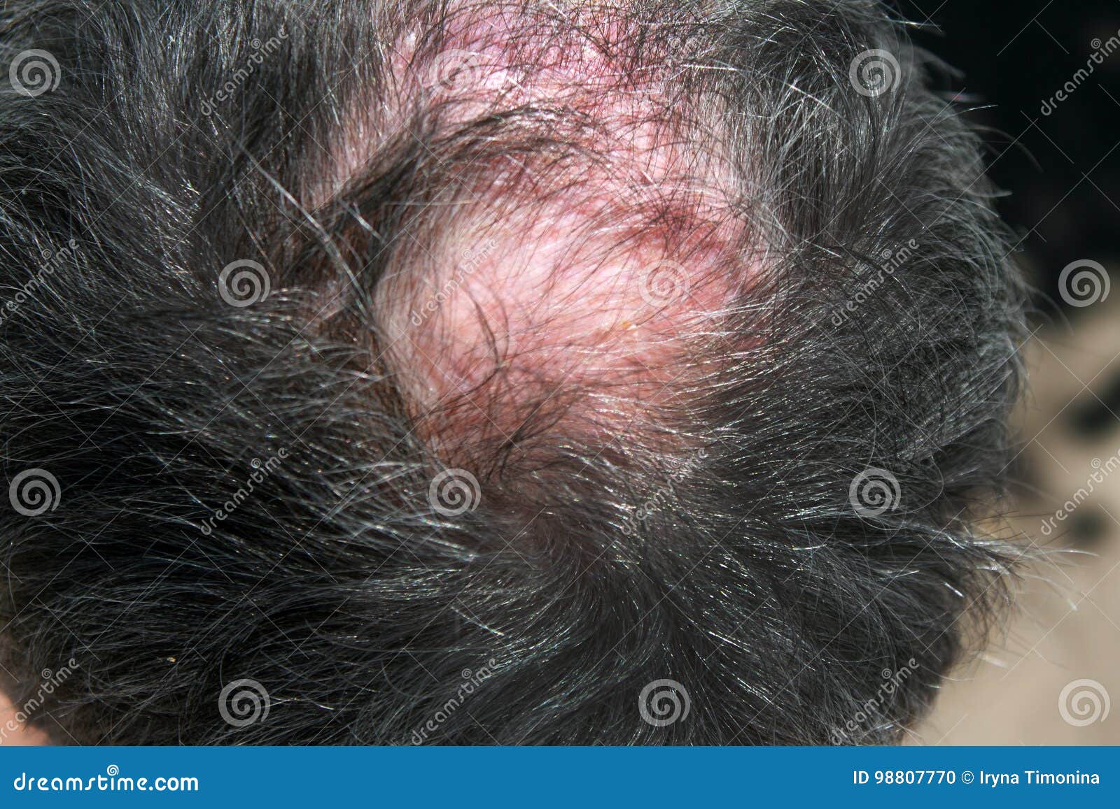 Bald Spot on His Head. Inflamed Red Skin Stock Photo - Image of ...