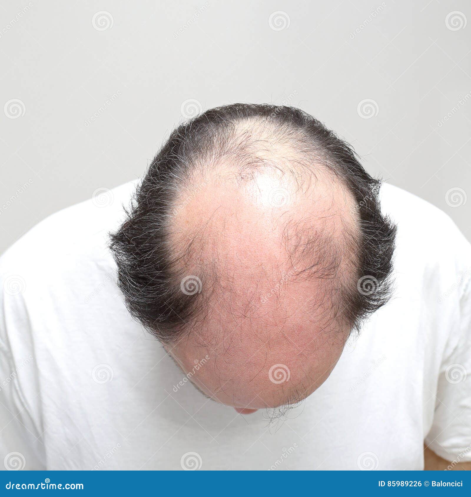 Bald stock photo. Image of hair, male, frustration, stress - 85989226