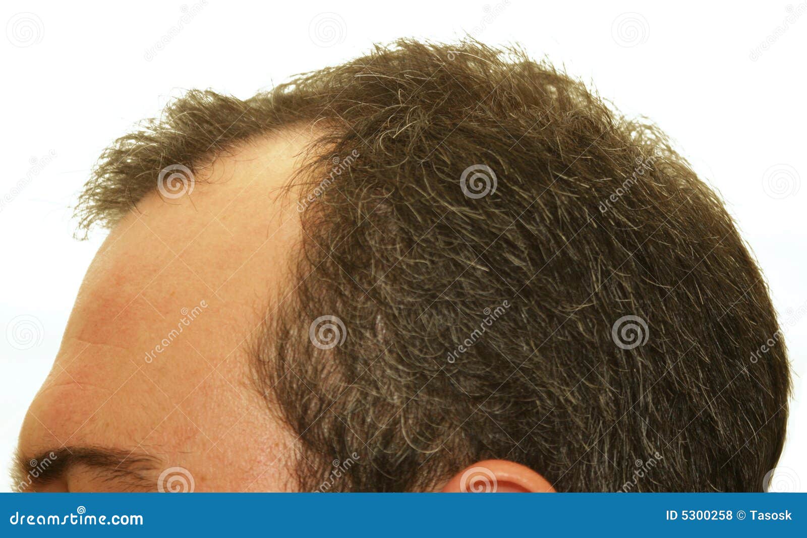 Balding head stock photo. Image of remedy, close, bald - 5300258