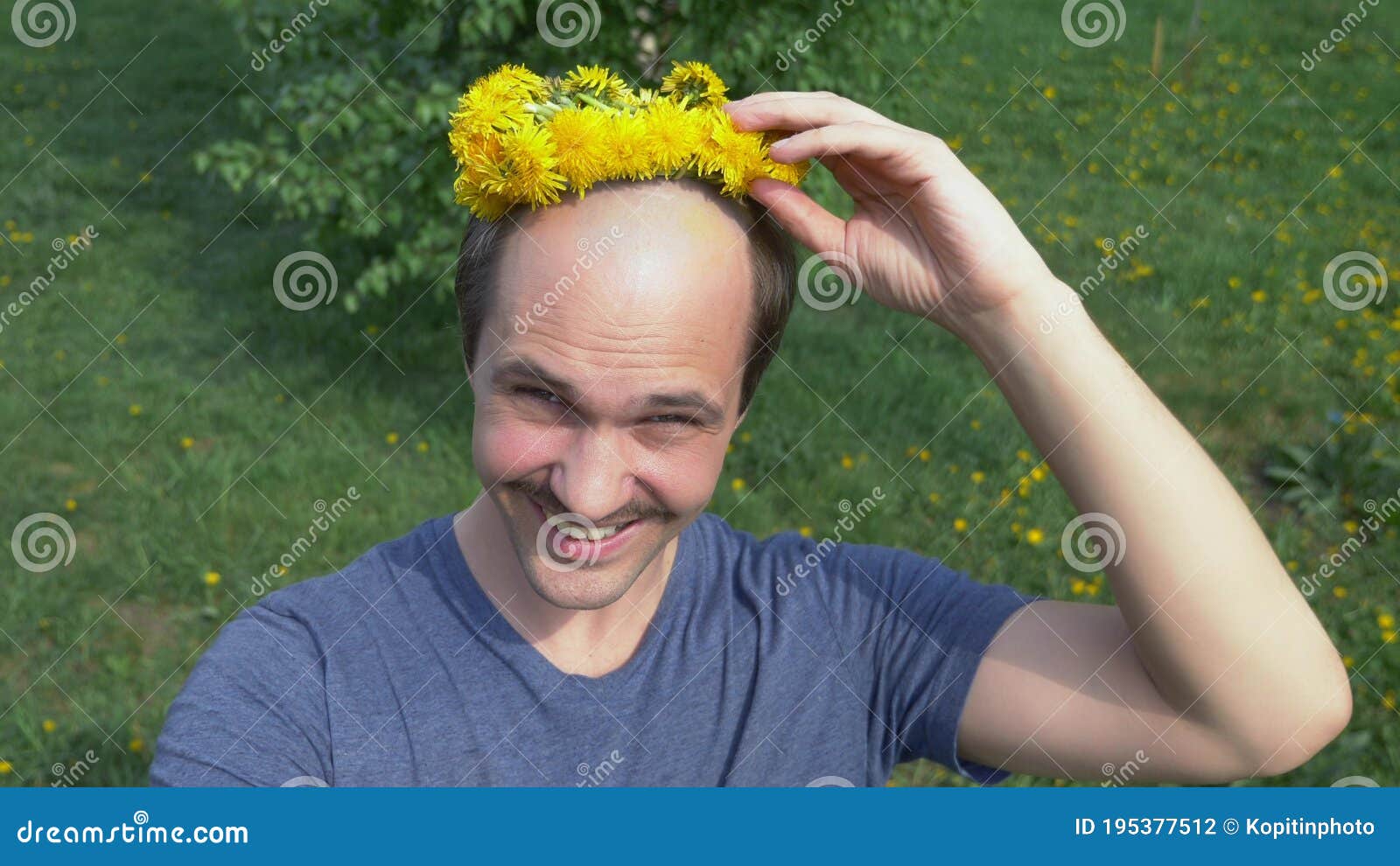 A Young Balding Bald Man Yells And Screams Holding His Head. The ... A Young Balding Bald Man Yells And Screams Holding His Head. The ...