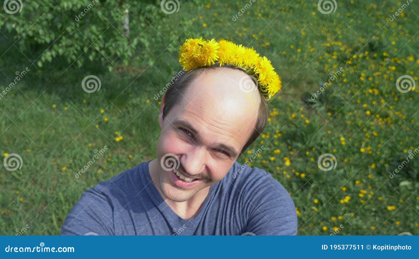 A Young Balding Bald Man Yells And Screams Holding His Head. The ... A Young Balding Bald Man Yells And Screams Holding His Head. The ...