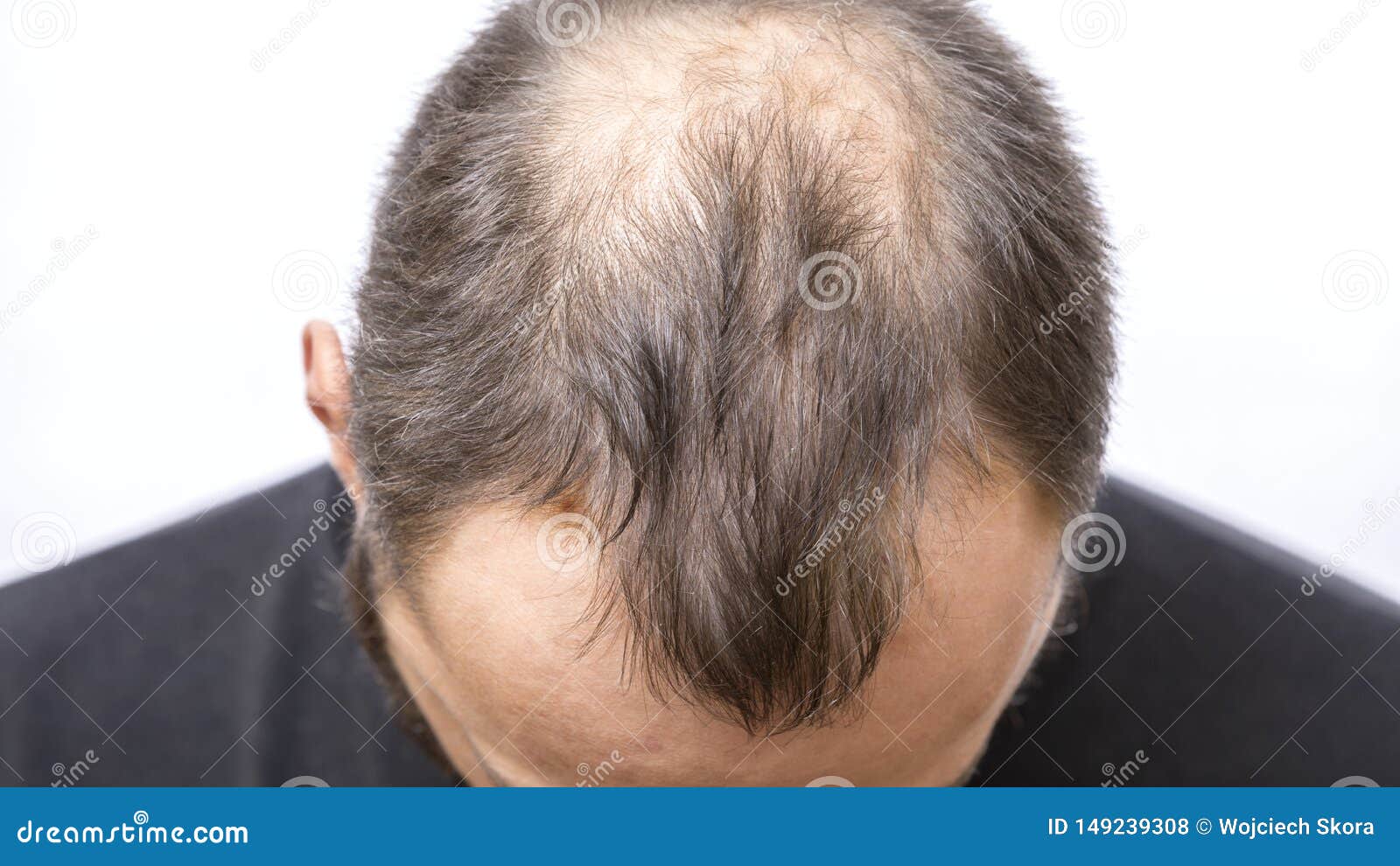 Balding Young Man, Hair Loss Problem Stock Photo - Image of dermatology ... Balding Young Man, Hair Loss Problem Stock Photo - Image of dermatology ...