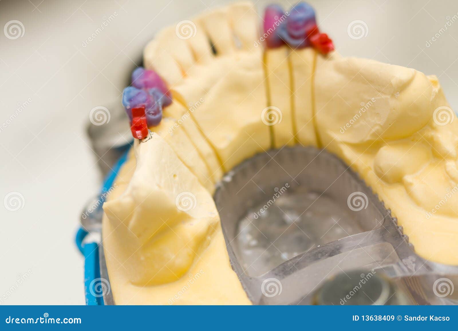 Ball Attachment for Denture Stock Image - Image of technician, model ...
