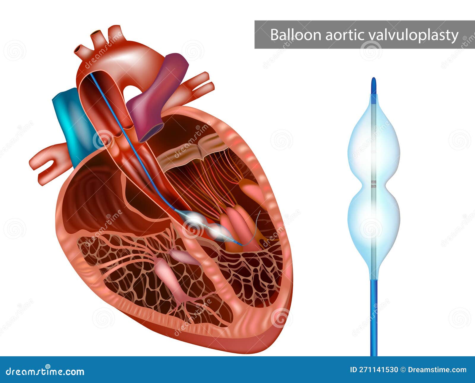 Balloon Aortic Valvuloplasty Or BAV. The Balloon Catheter Is Advanced ... Balloon Aortic Valvuloplasty Or BAV. The Balloon Catheter Is Advanced ...