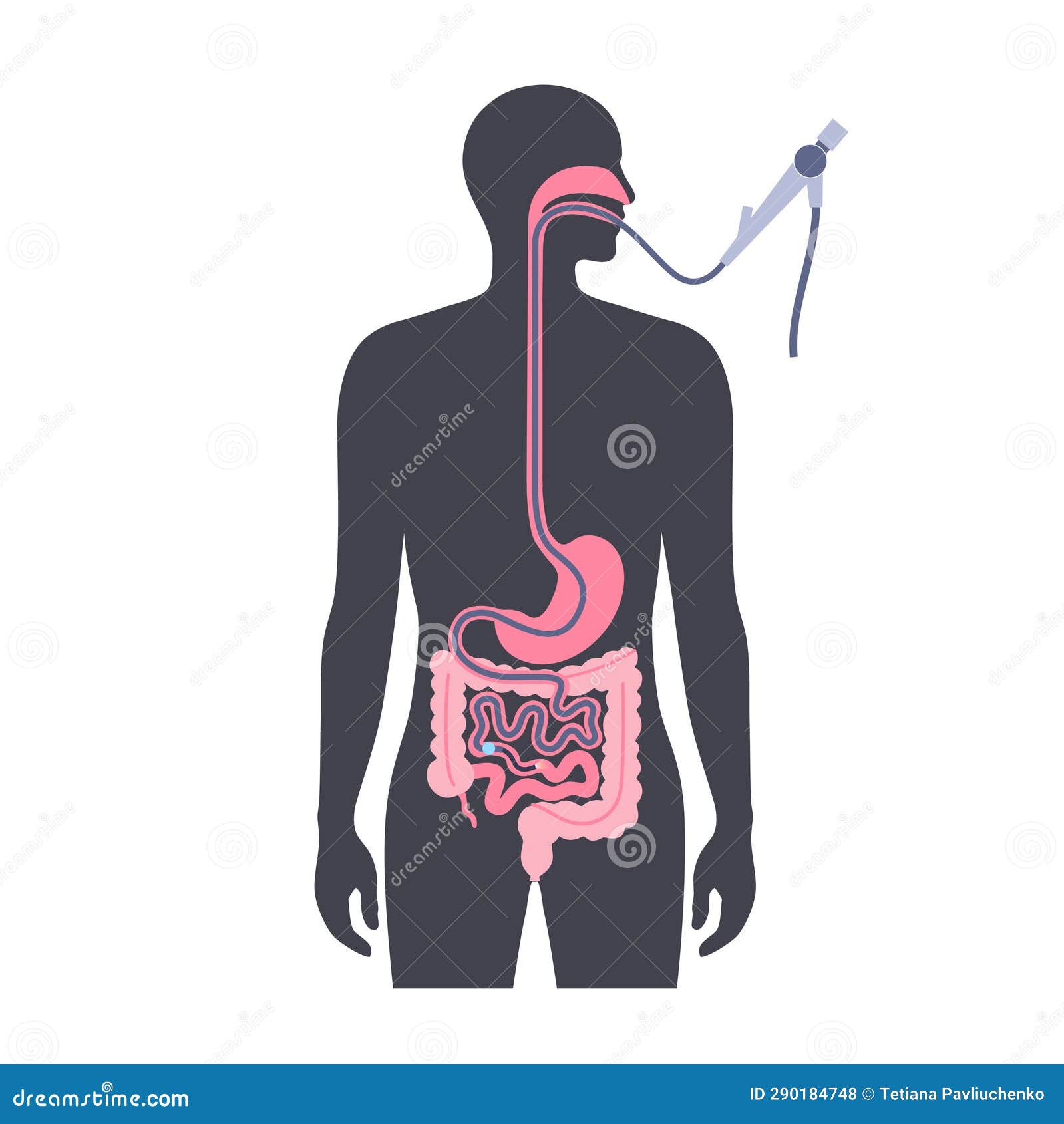 Balloon Assisted Enteroscopy Stock Illustration - Illustration of ...