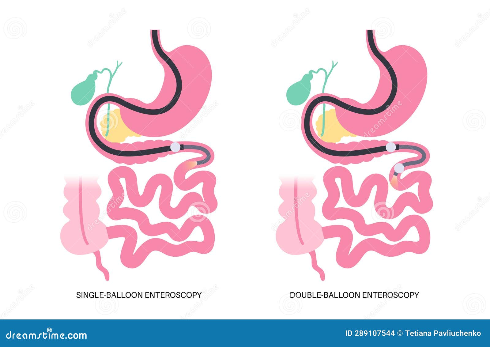 Balloon Assisted Enteroscopy Stock Vector - Illustration of double ...