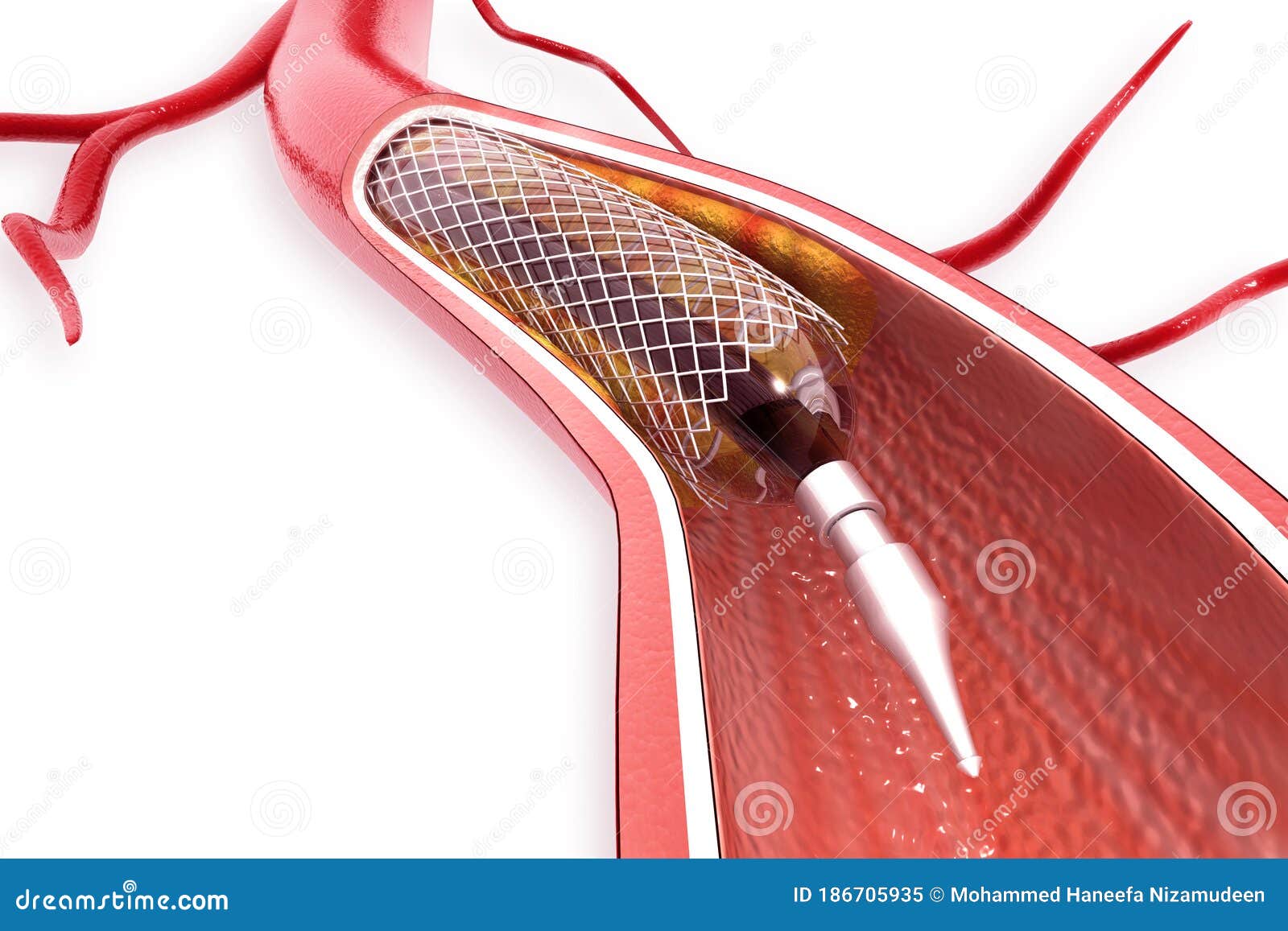 Balloon Expandable Stent stock illustration. Illustration of operation ...