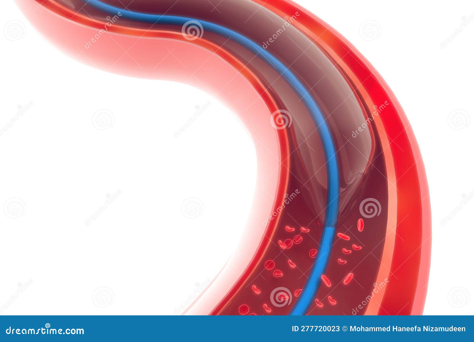 Balloon Expandable Stent, Anatomical Concept Stock Illustration ...