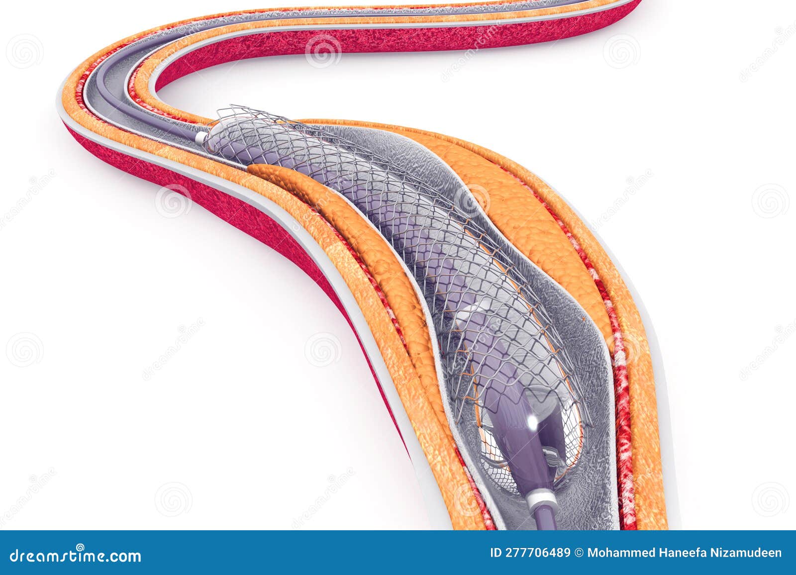 Balloon Expandable Stent Royalty-Free Cartoon | CartoonDealer.com ...