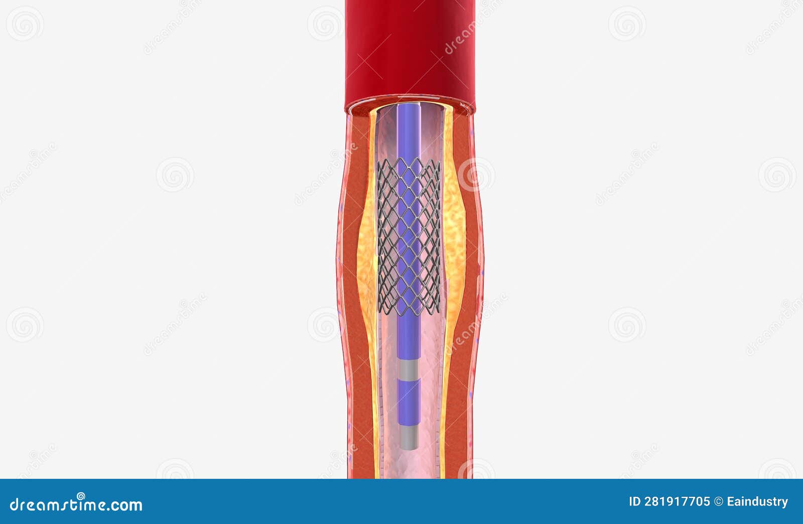 The Balloon Expends, Widening the Wire Mesh Stent and the Artery Stock ...