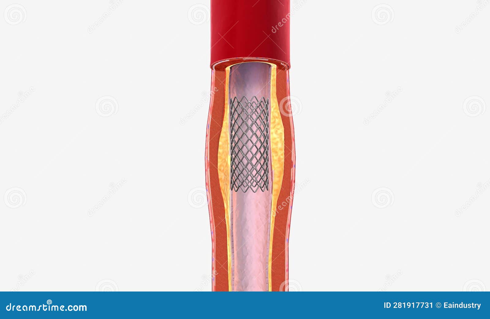 The Balloon Expends, Widening the Wire Mesh Stent and the Artery Stock ...