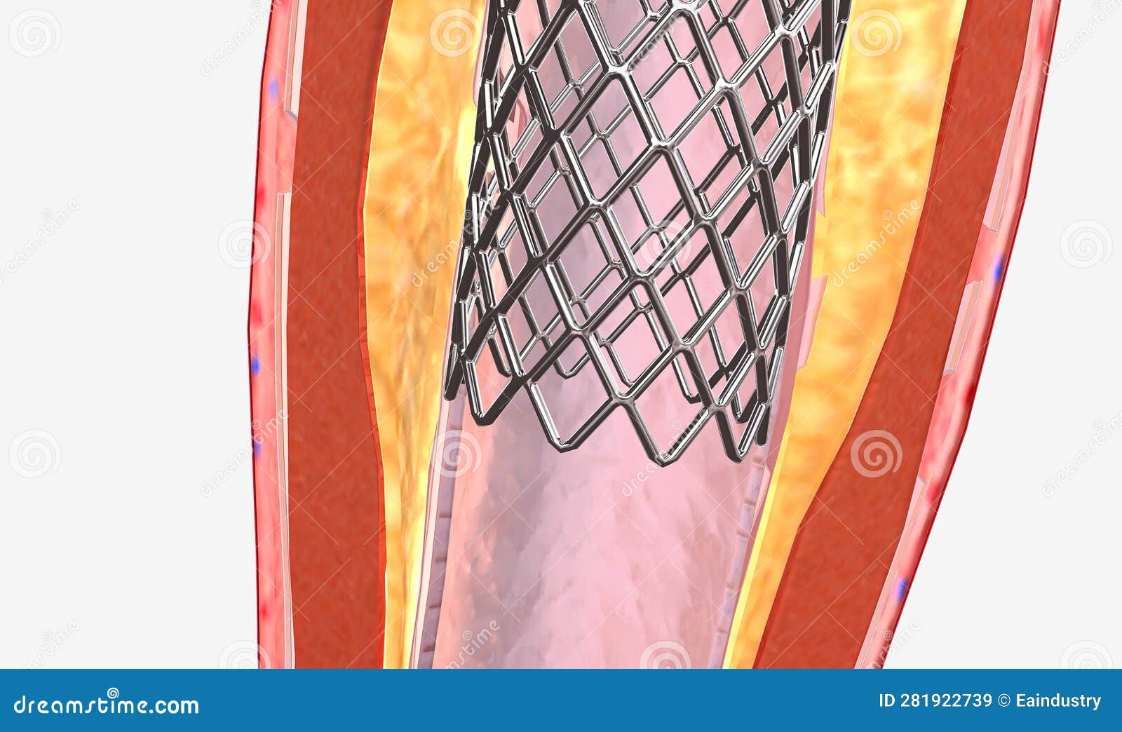 The Balloon Expends, Widening the Wire Mesh Stent and the Artery Stock ...