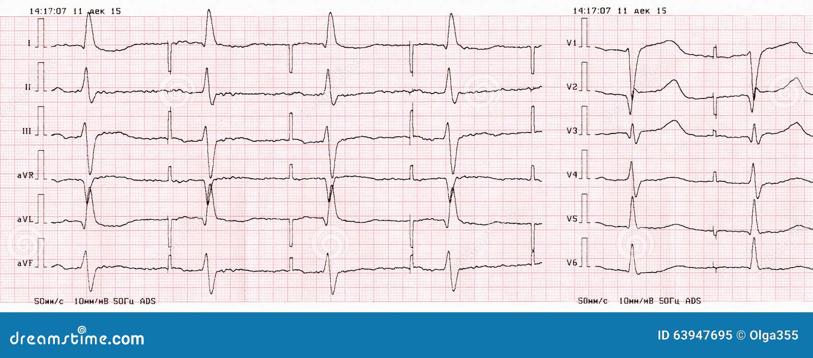Band ECG Med Pacemakerrytm (atrial Stega) Fotografering för Bildbyråer ...