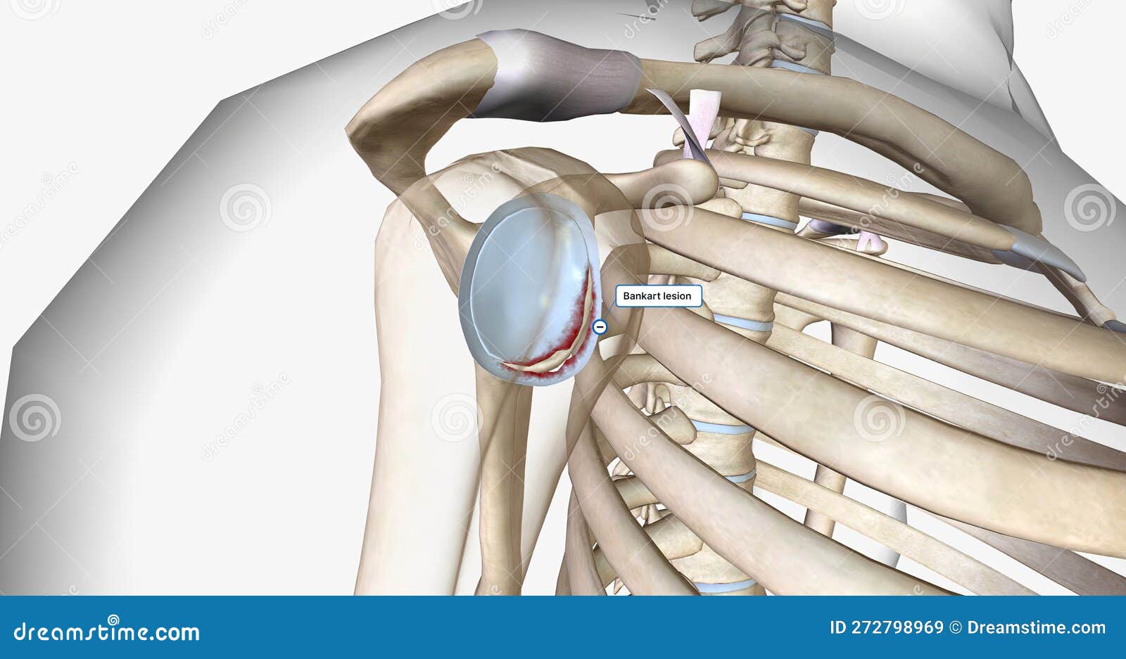 A Bankart Lesion Occurs As the Result of a Forward Shoulder Dislocation ...