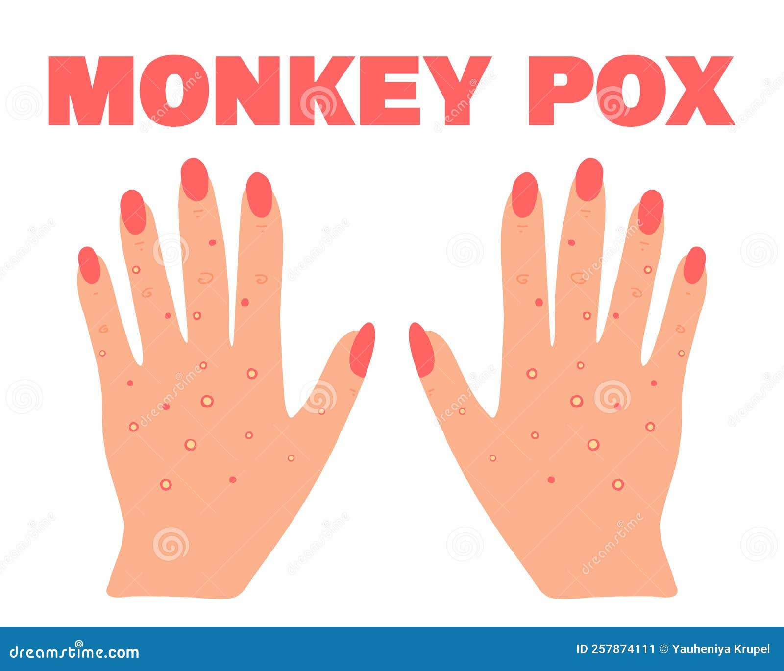 Banner With Smallpox Monkey. Monkey Pox. Hands With A Rash. Smallpox ...