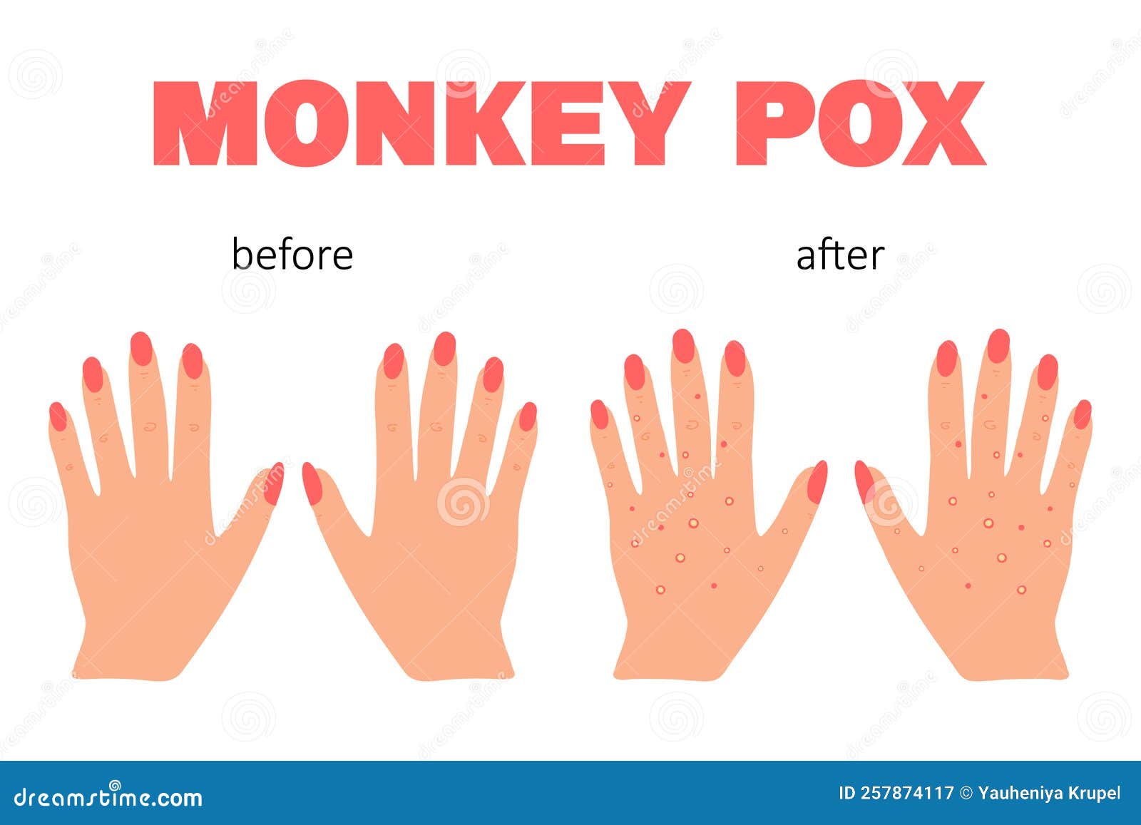 Banner With Smallpox Monkey. Monkey Pox. Hands With A Rash. Smallpox ...