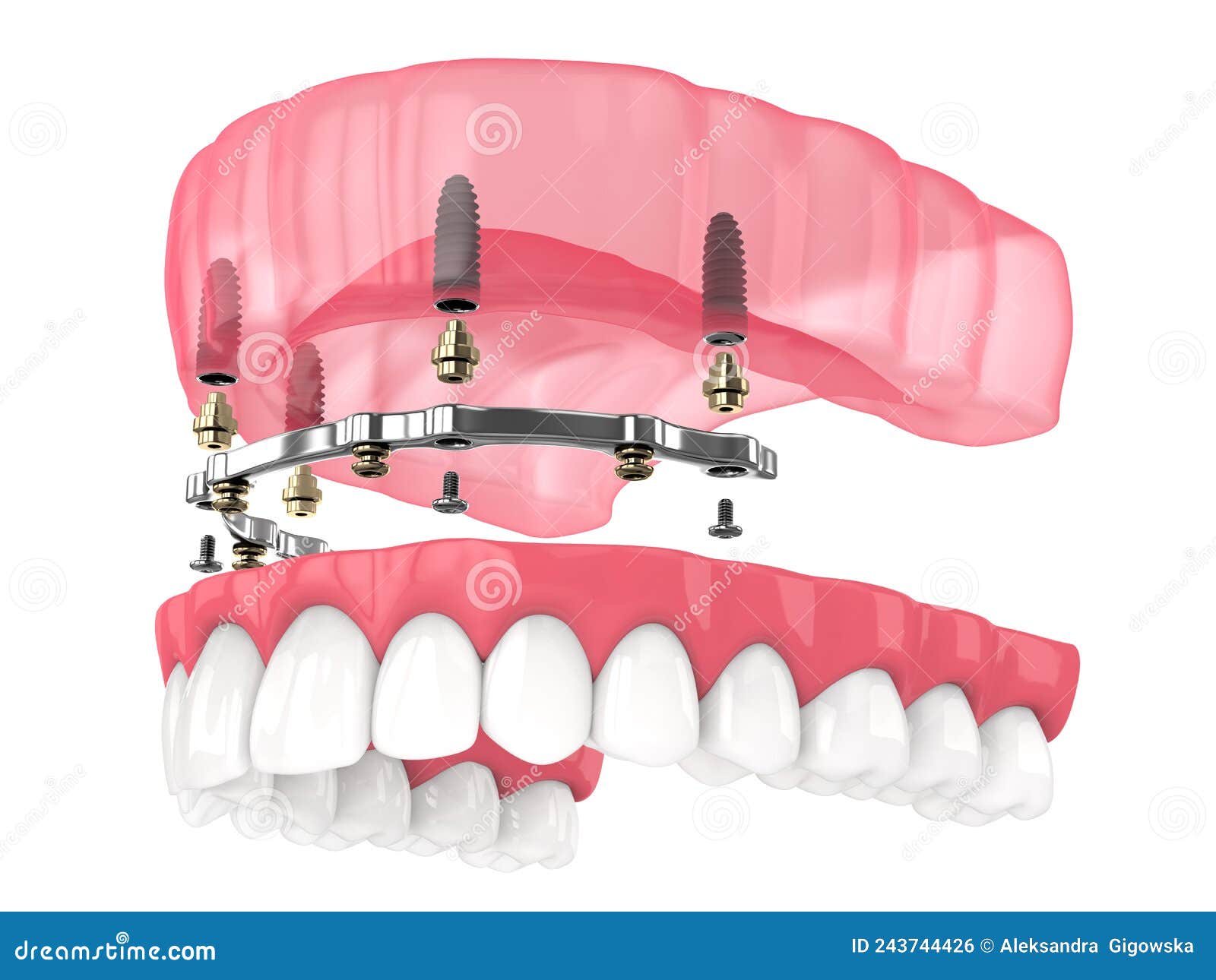 Bar Retained Removable Overdenture Installation Supported by Implants ...