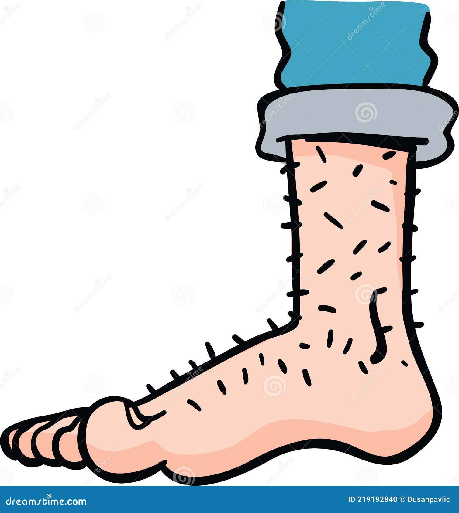 Twisted Foot- Ankle Sprain - Illustration Cartoon Vector ...
