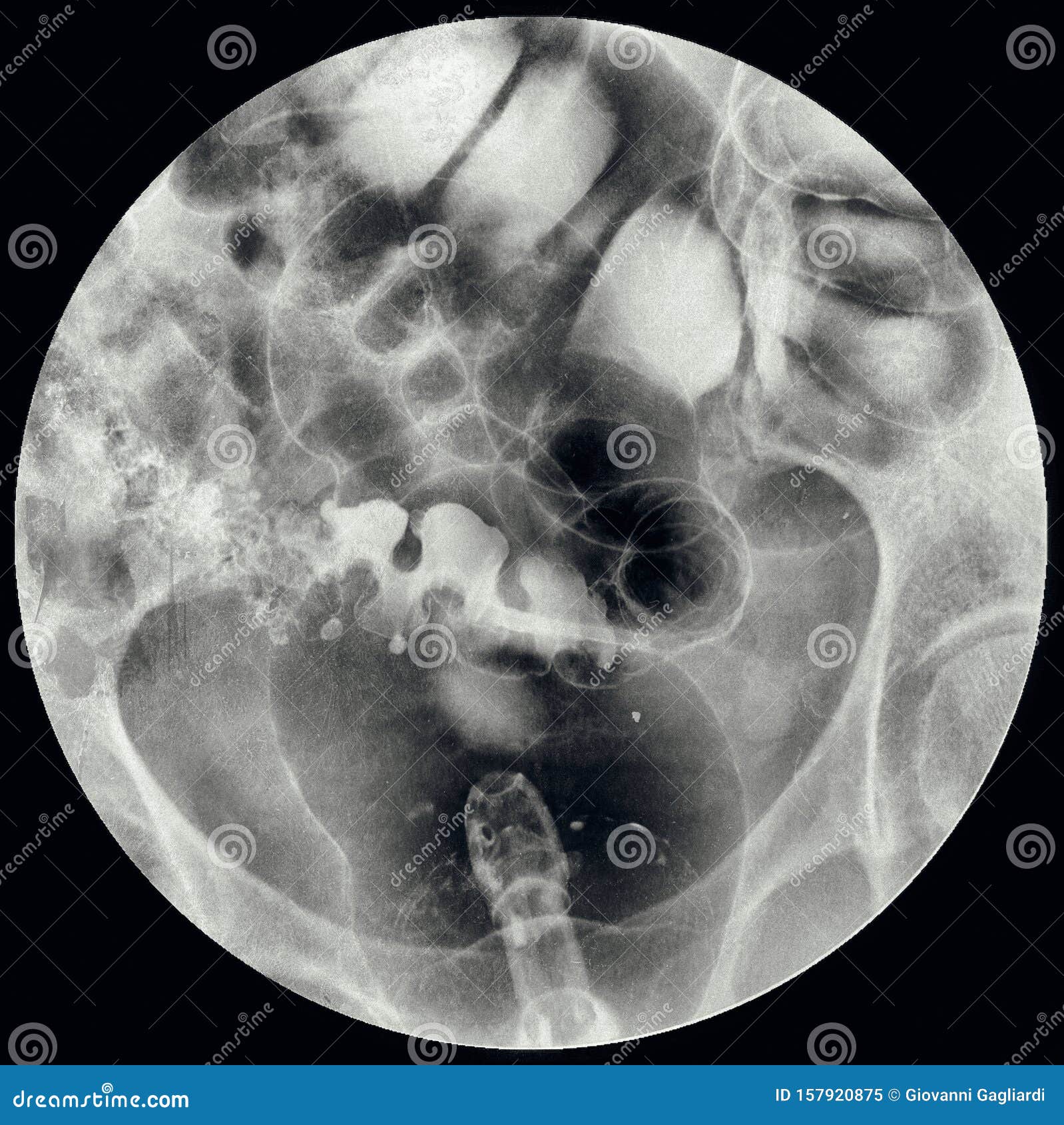 Barium Enema, Double Contrast Study, Colorectal X-ray Stock Image ...