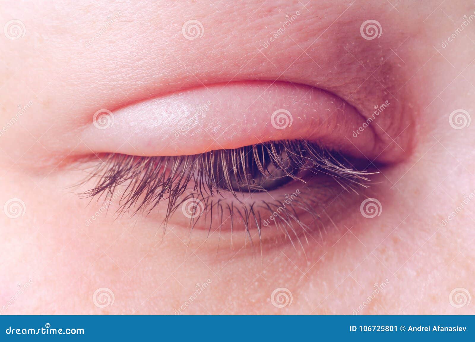 Barley Infection on the Eye Stock Image - Image of infection ...