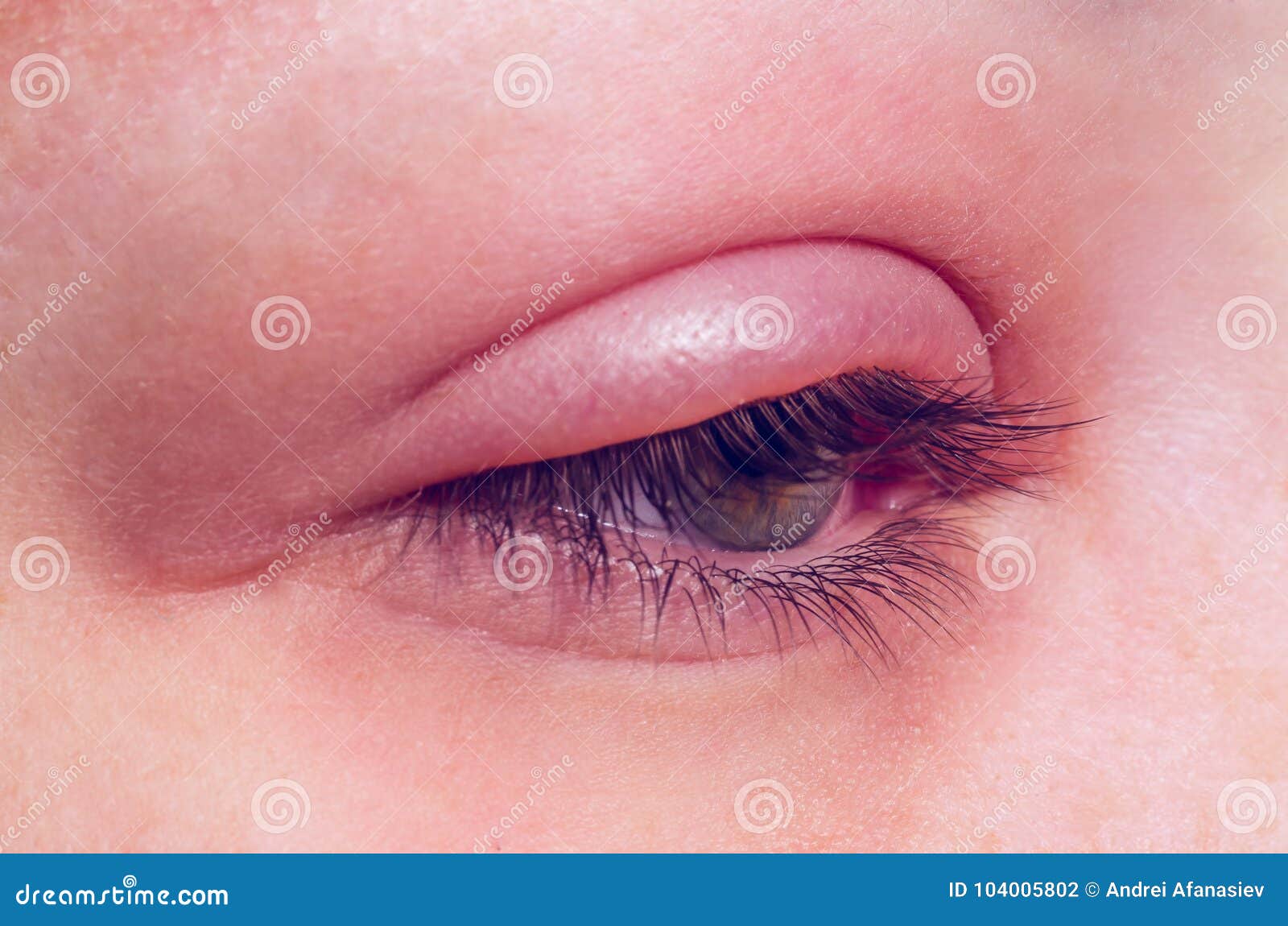 Barley Infection on the Eye Stock Photo - Image of pimples, illness ...