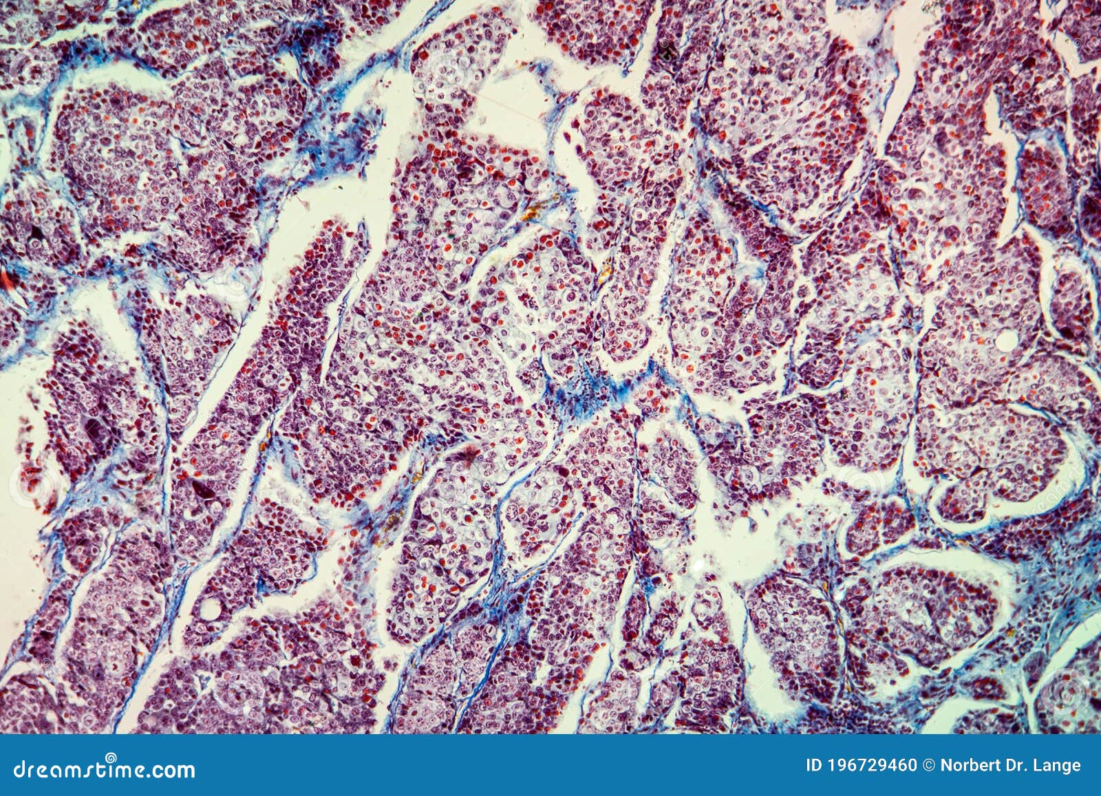 Basal Cell Cancer Diseased Tissue Stock Photo - Image of pathology ...