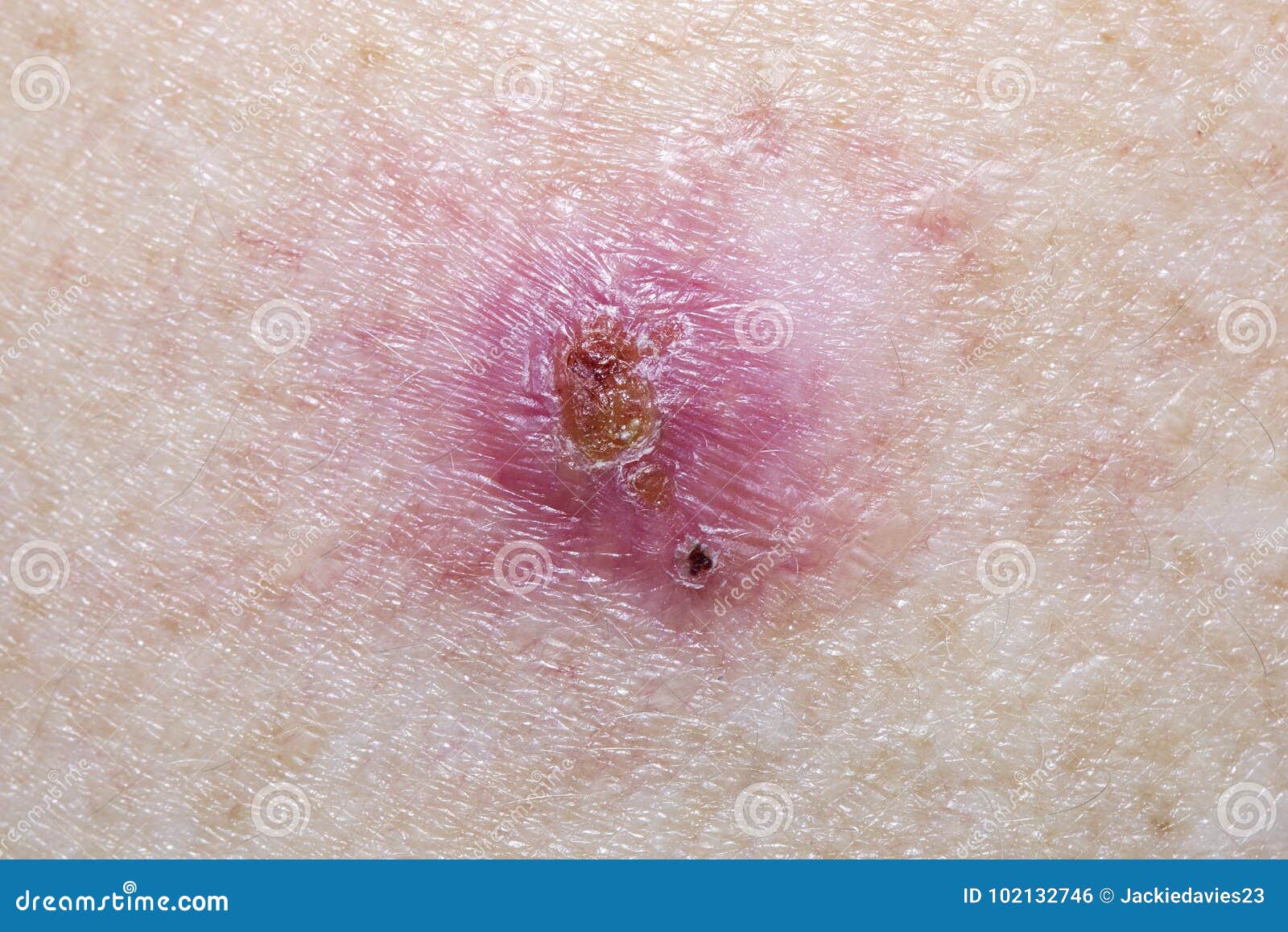 Basal Cell Carcinoma stock photo. Image of medical, basal - 102132746