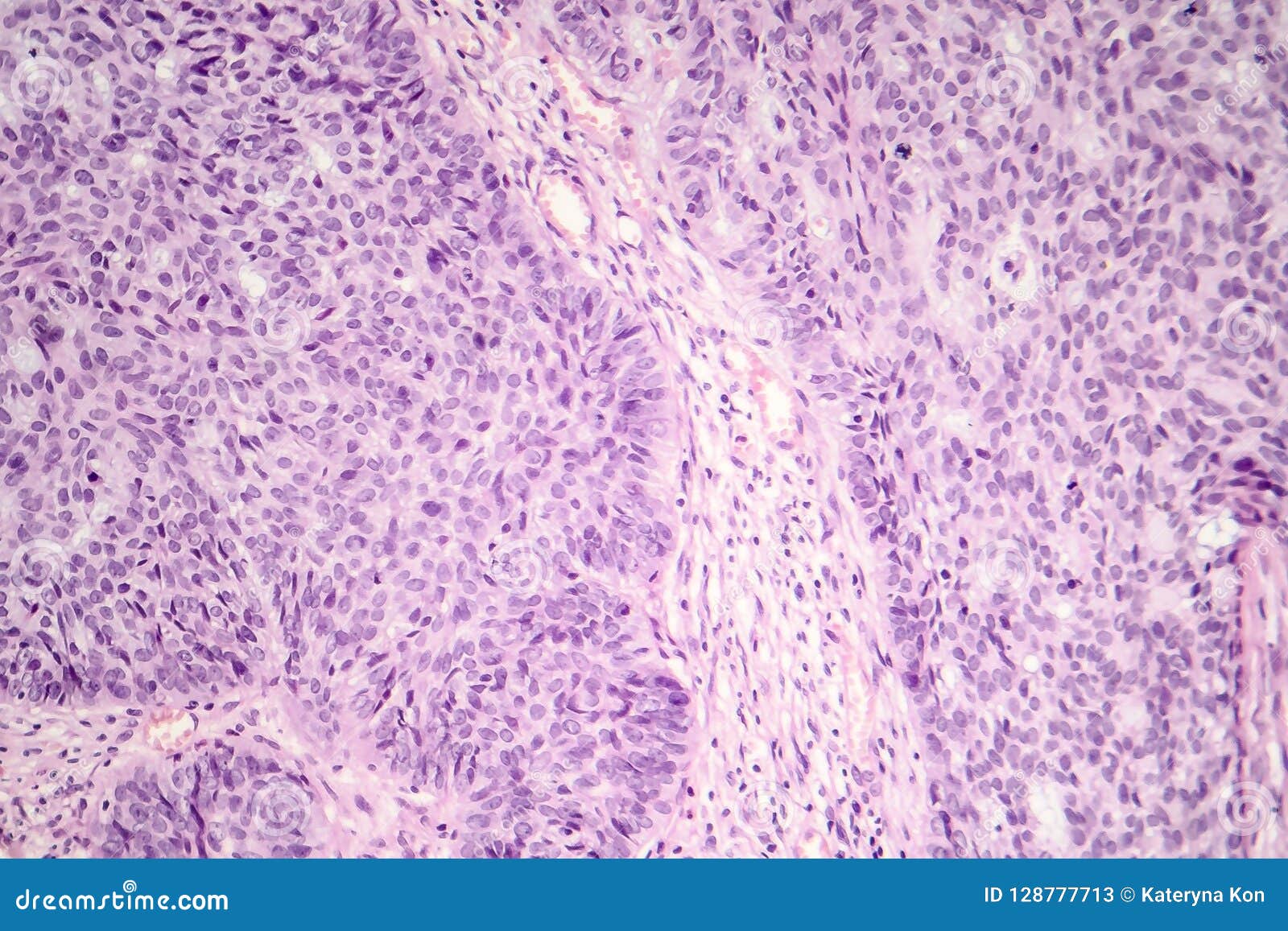 Basal cell carcinoma stock image. Image of stain, medical - 128777713