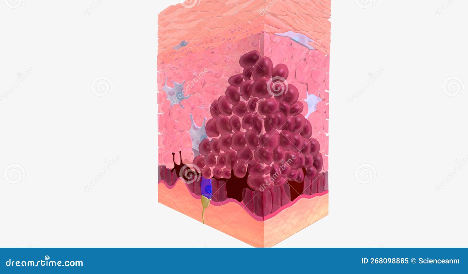 Basal Cell Carcinoma in Tissue, Stage 0 Stock Illustration ...