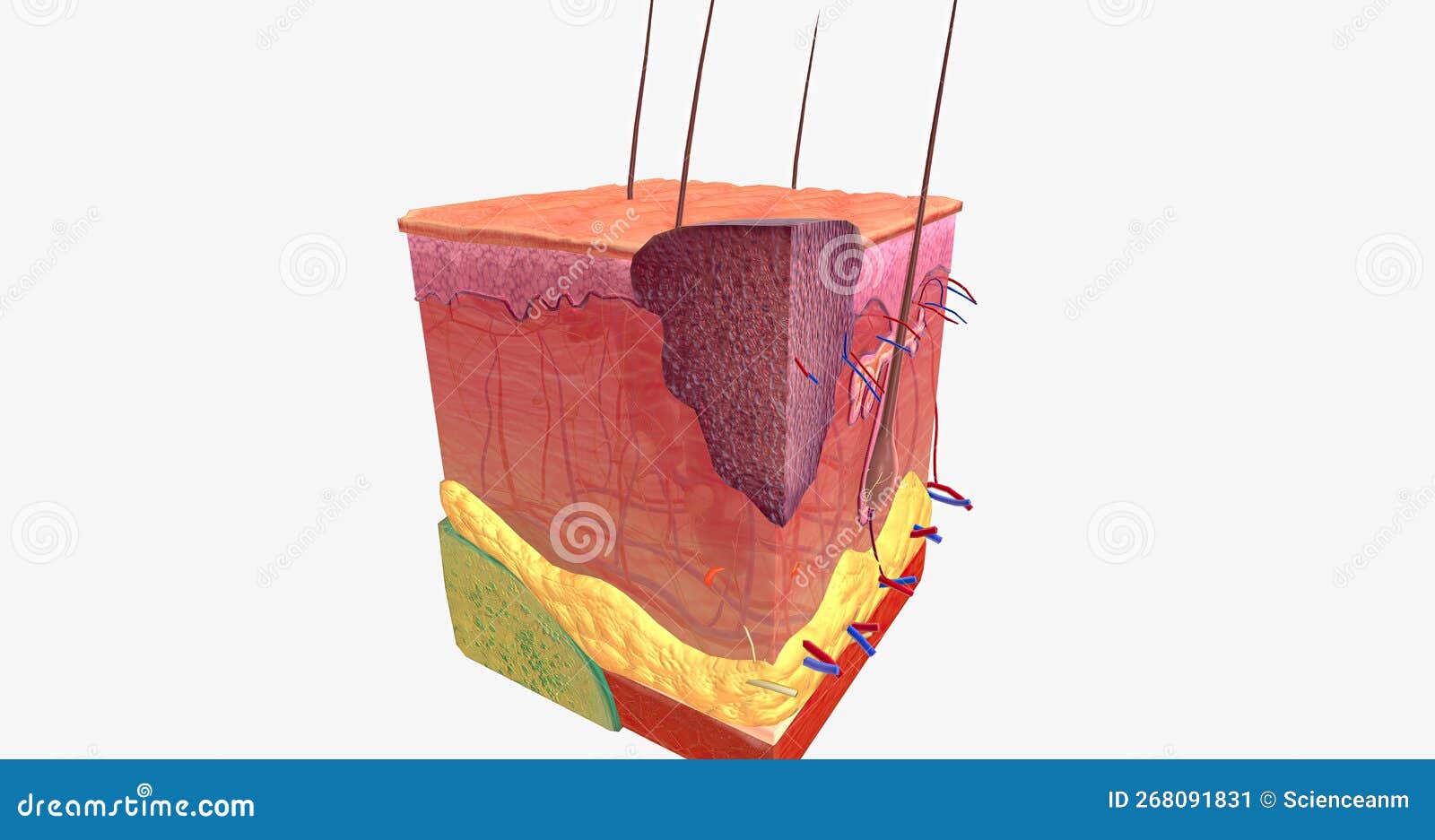 Basal Cell Carcinoma in Tissue, Stage 1 Stock Illustration ...