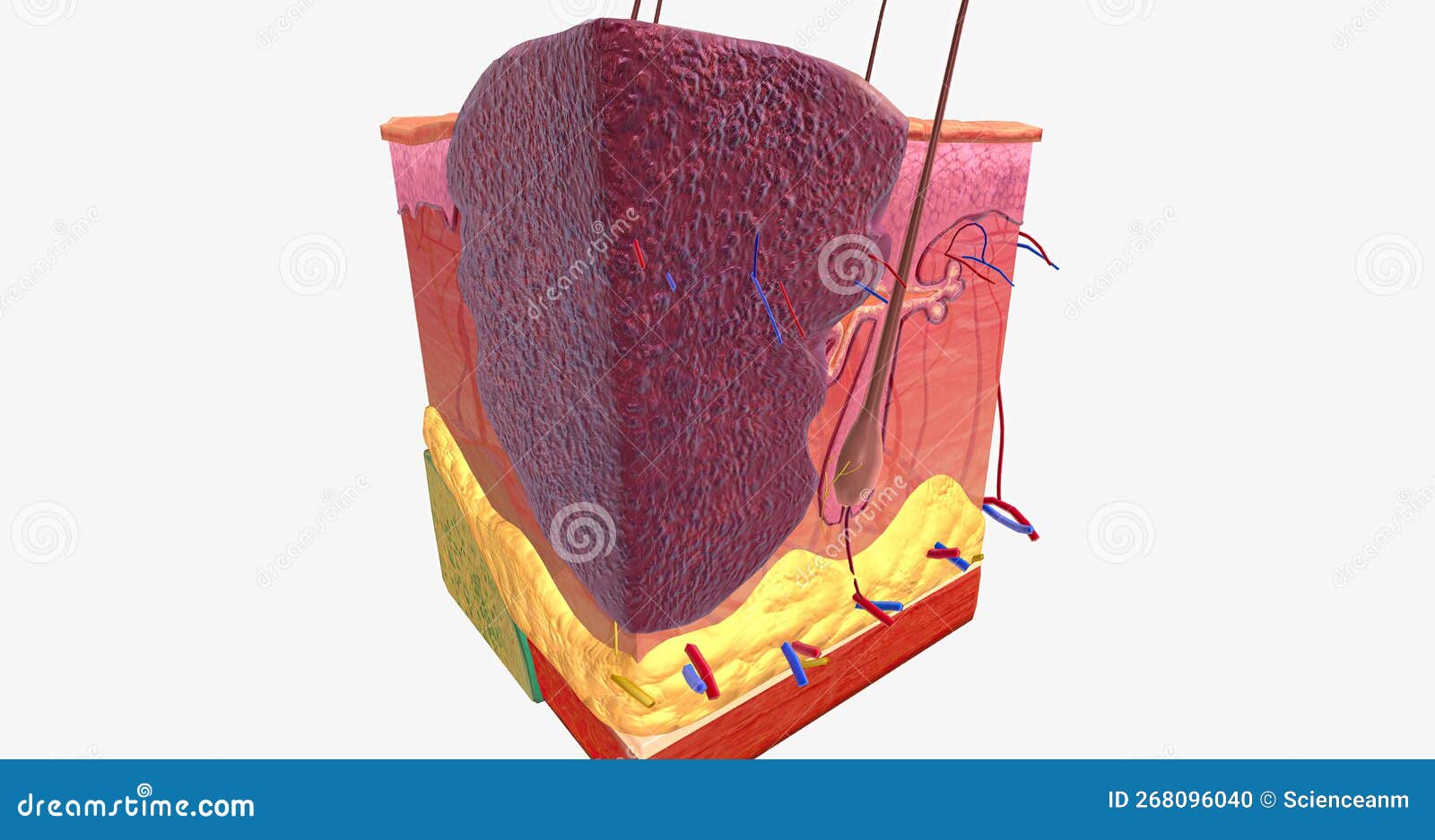 Basal Cell Carcinoma in Tissue, Stage II Stock Illustration ...