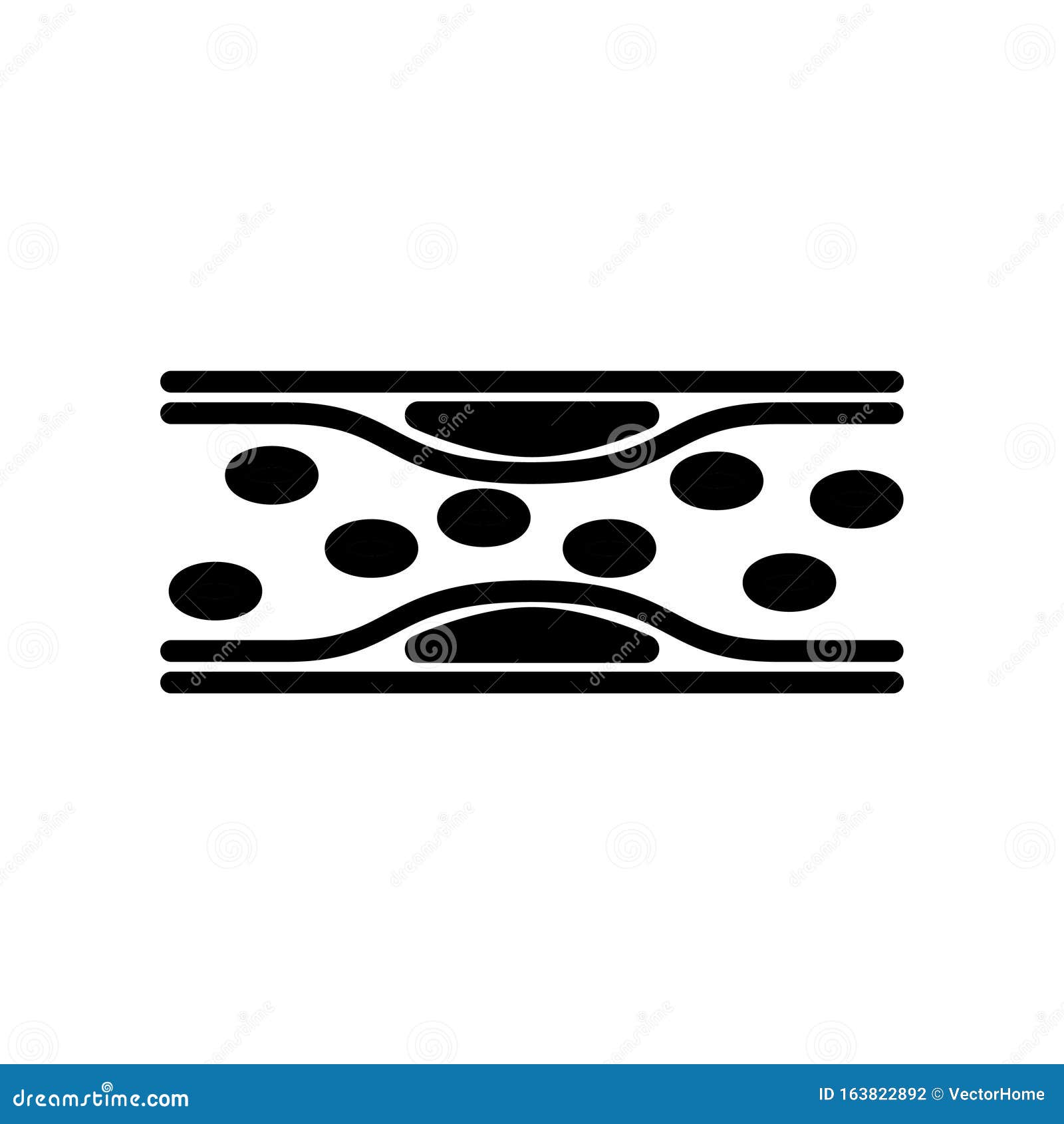 Artery Blocked With Cholesterol Illustration Blood Pressure Design, The ...