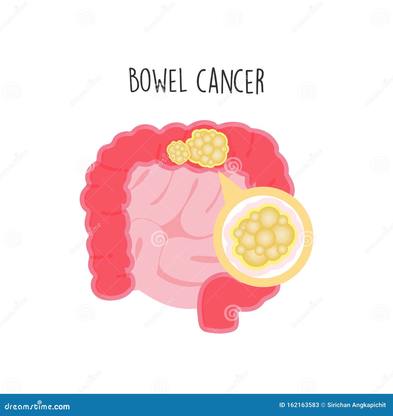 Bowel Cancer Flat Illustration. Stock Illustration - Illustration of ...