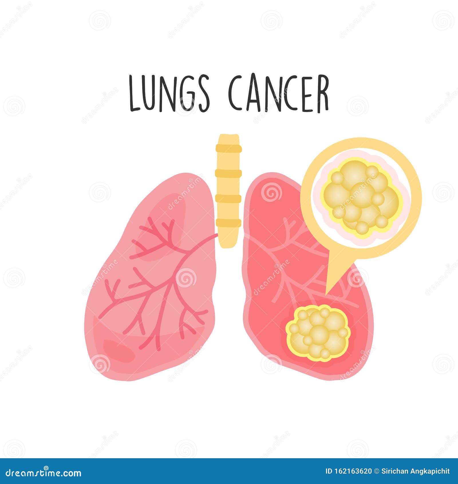 Lungs Cancer Line Black Icon. Human Organ Concept. Malignant Neoplasm ...