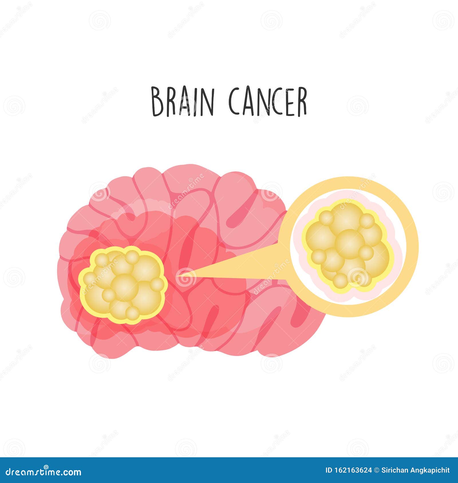 Brain Cancer Flat Illustration. Stock Illustration - Illustration of ...