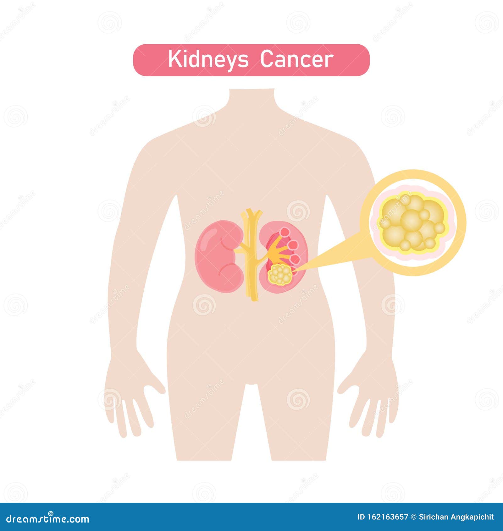 Kidney Cancer Diagram .Vector Illustration in Flat Style. Stock ...